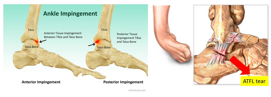 ankle impingement - Teo Orthopaedic Specialist Clinic